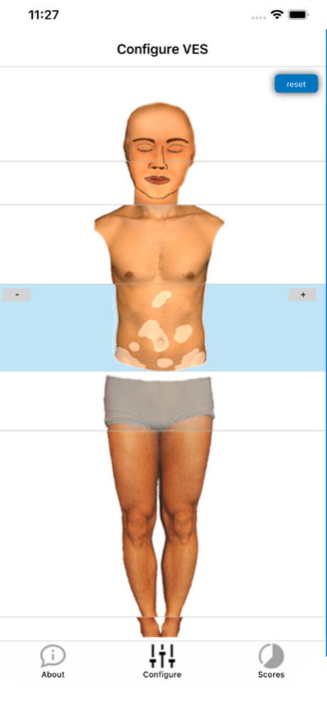 vitiligo scoring system